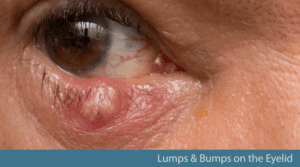 Lumps and Bumps on the Eyelid: Causes and Solutions - Illinois Eye Center